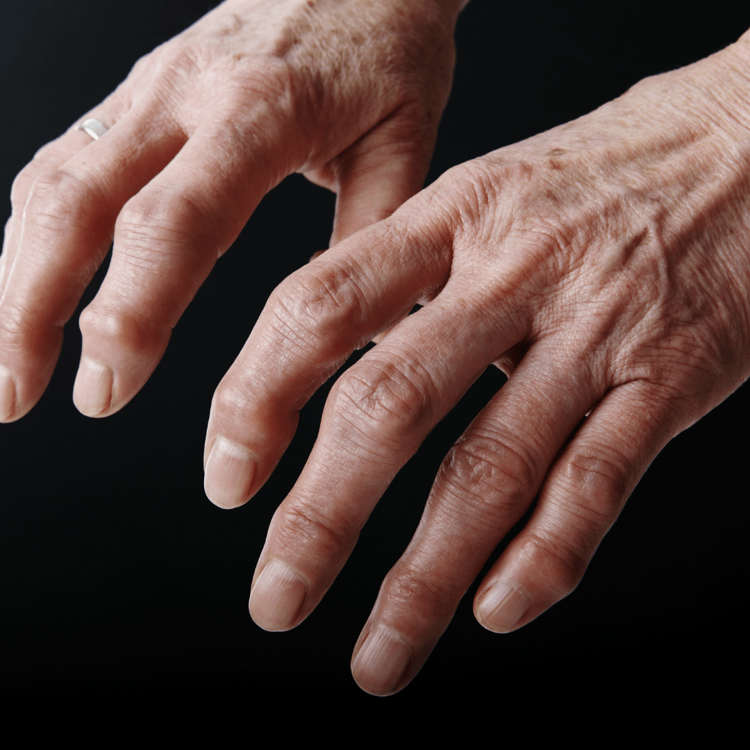 Arthrosis: types, symptoms and treatment - I-Tech Medical Division